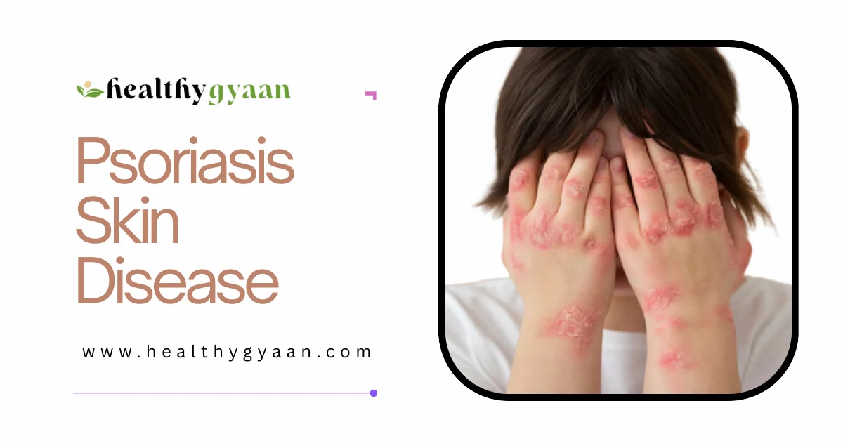 Psoriasis Skin Disease Causes Symptoms Treatment and Complete Guide to ...